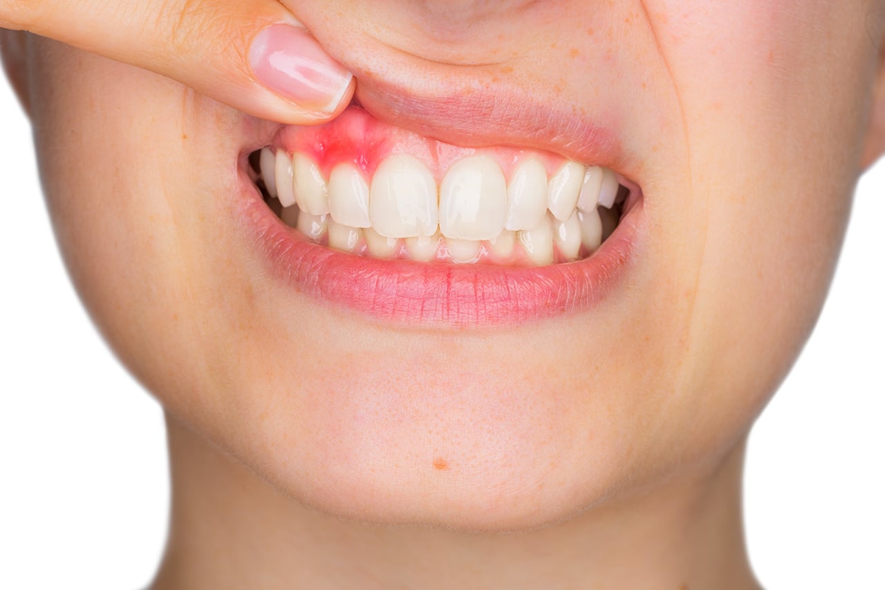 Gingivitis: What is It and How is it Treated?
