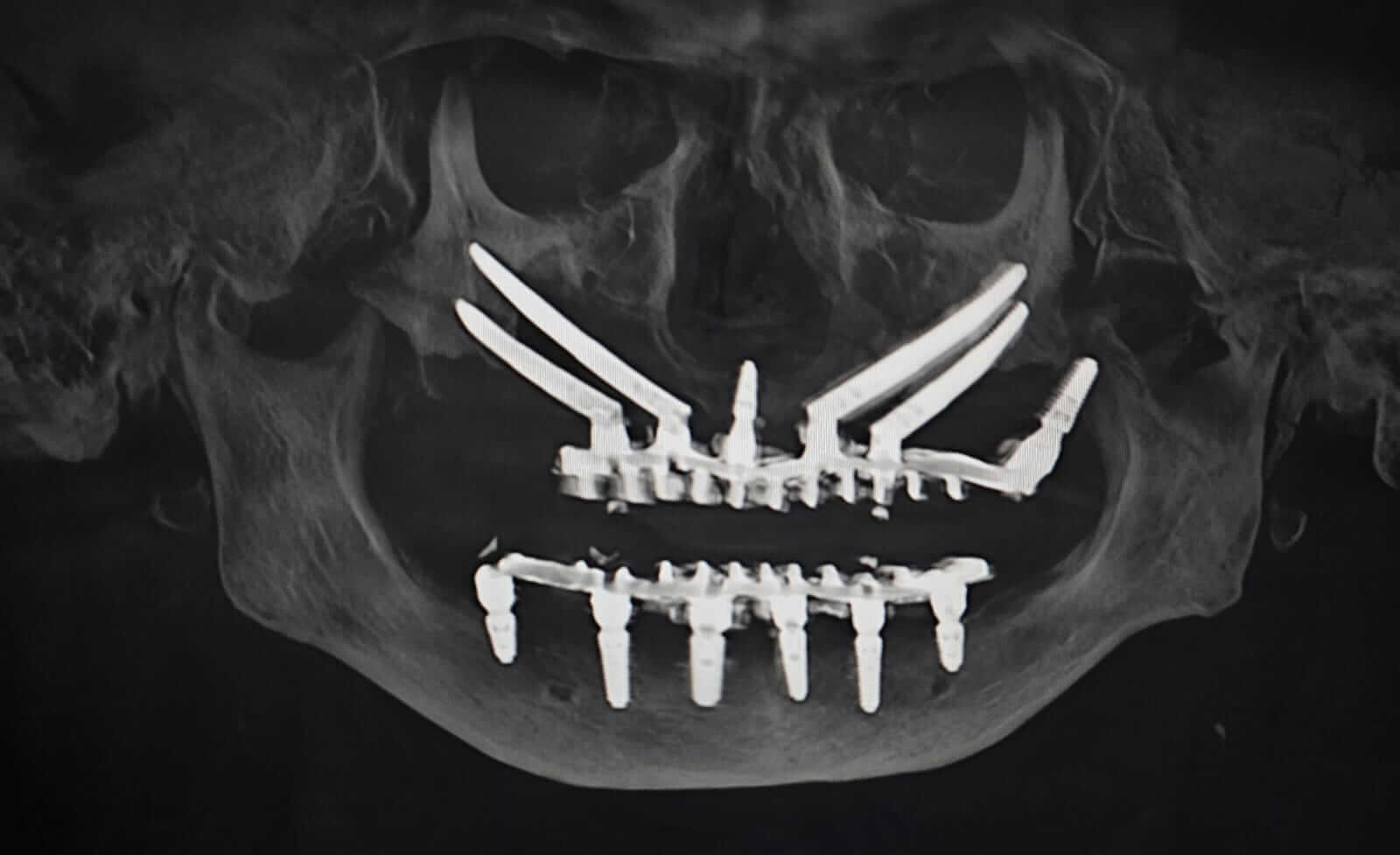 Exploring Zygomatic Implants In Albania | City Dental Clinic