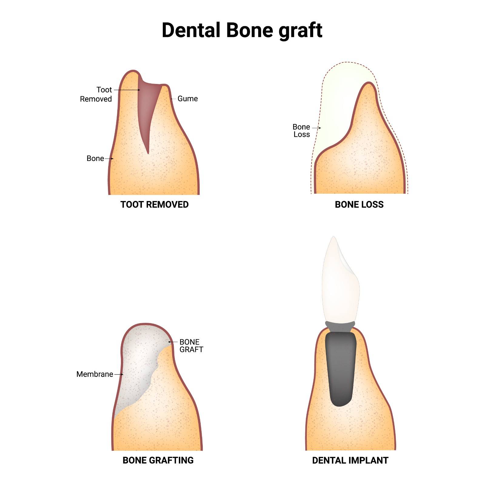 Understanding And Preparing For A Bone Grafting Procedure