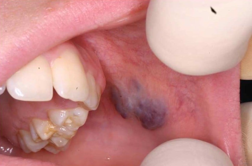 Cancer Lump Inside Cheek Tissue